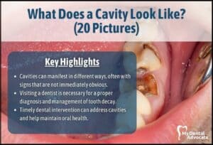 What Does a Cavity Look Like? (20 Pictures)