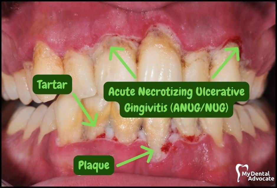 📸 What Does Gingivitis Look Like? (20 Gum Disease Pictures)