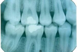 FMX Dental X-ray Guide (Are They Safe?)